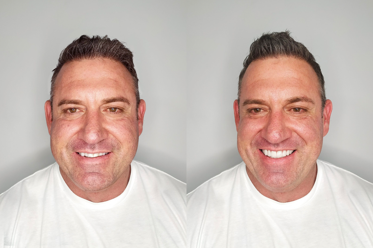 Dental Veneers v2 - Allo Dental